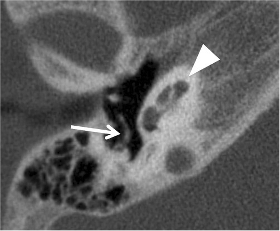 CHARGE-Syndrom | pacs