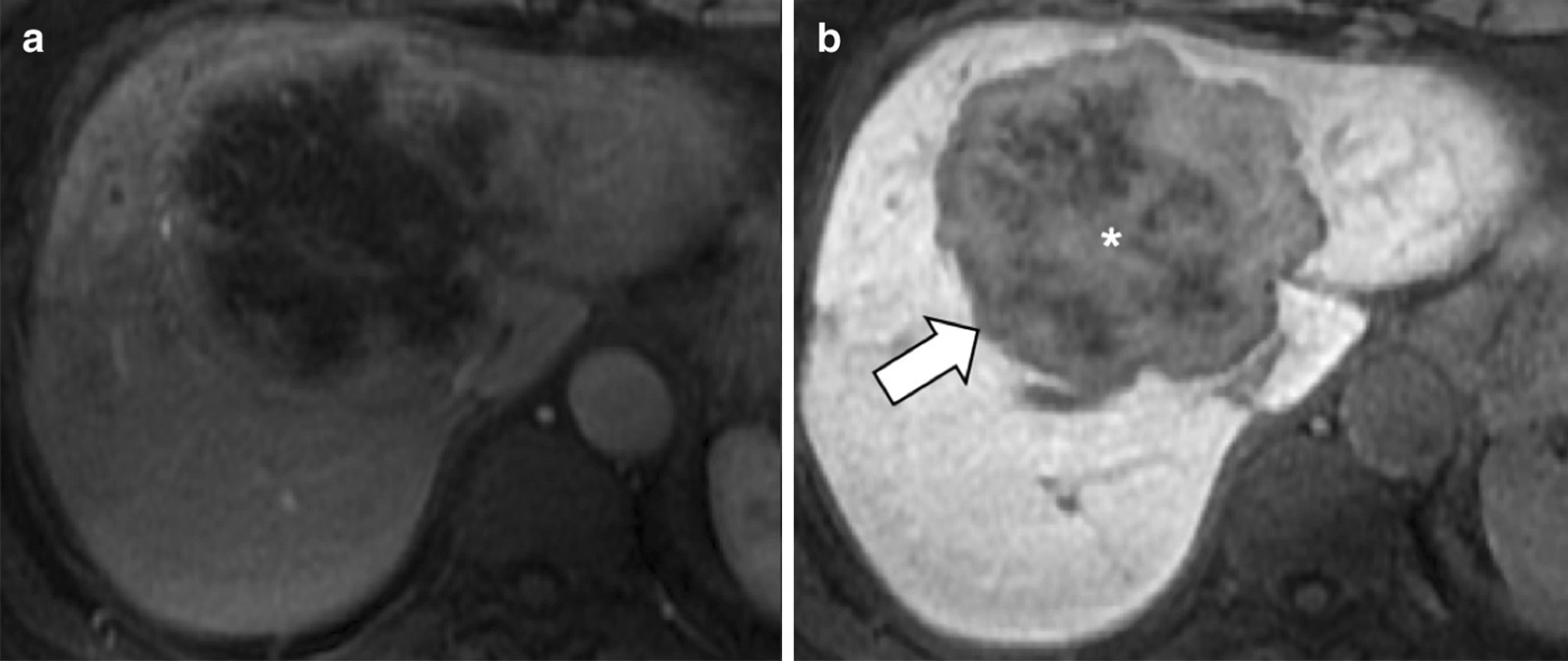 liver lesions hyperintense on hepatobiliary phase | pacs