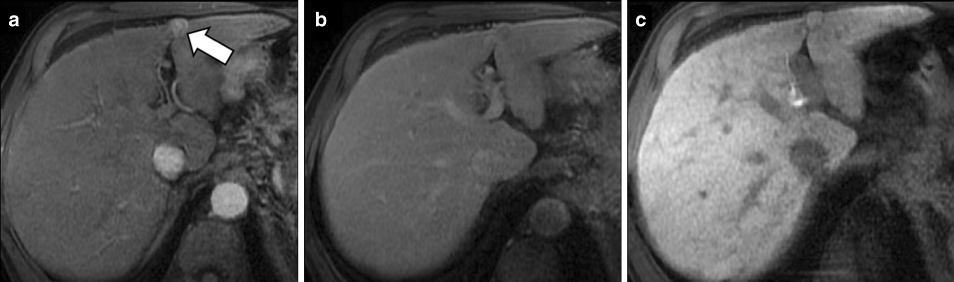 liver lesions hyperintense on hepatobiliary phase | pacs