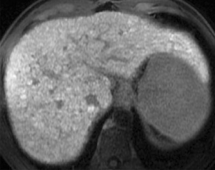 liver lesions hyperintense on hepatobiliary phase | pacs