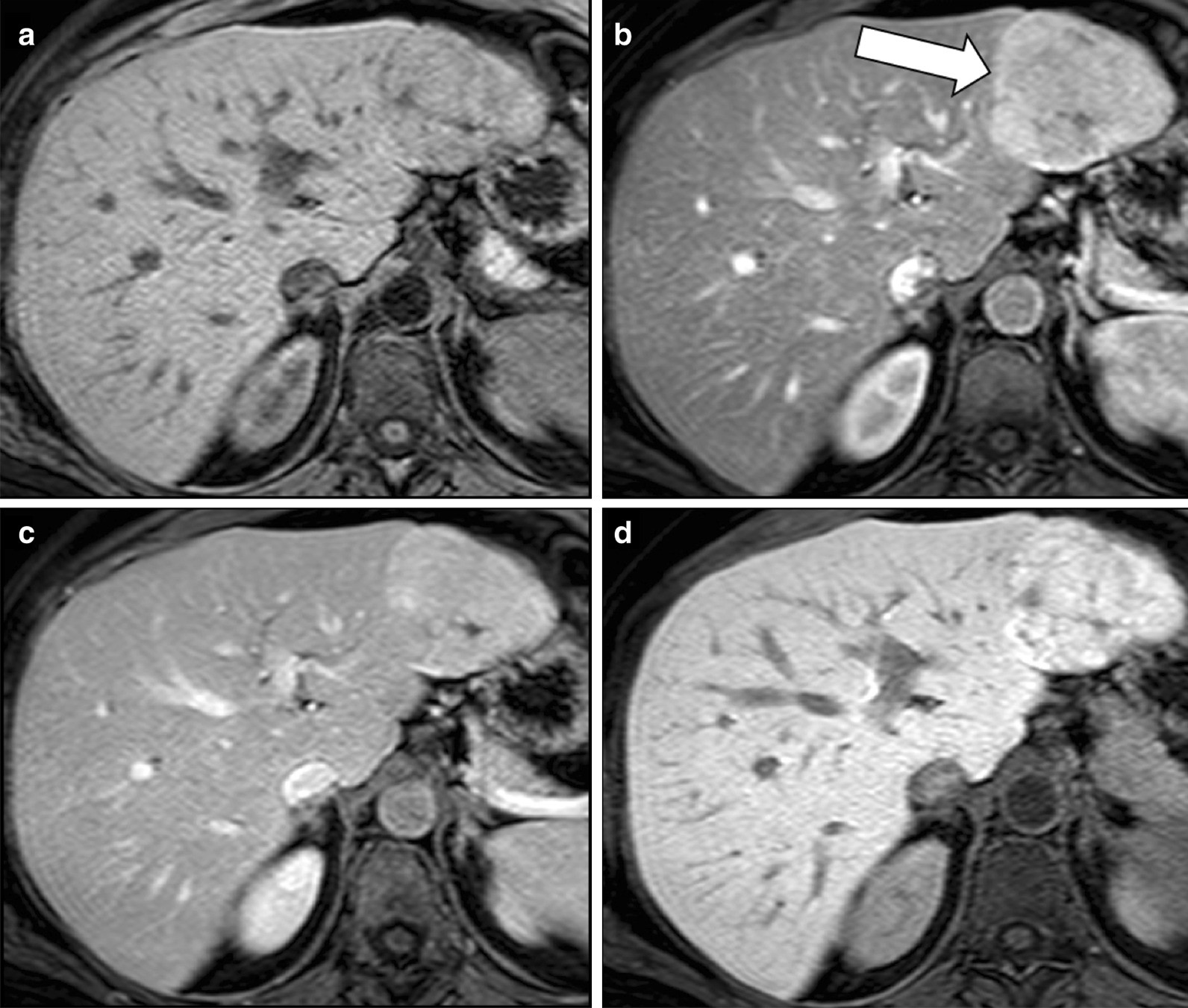 liver lesions hyperintense on hepatobiliary phase | pacs