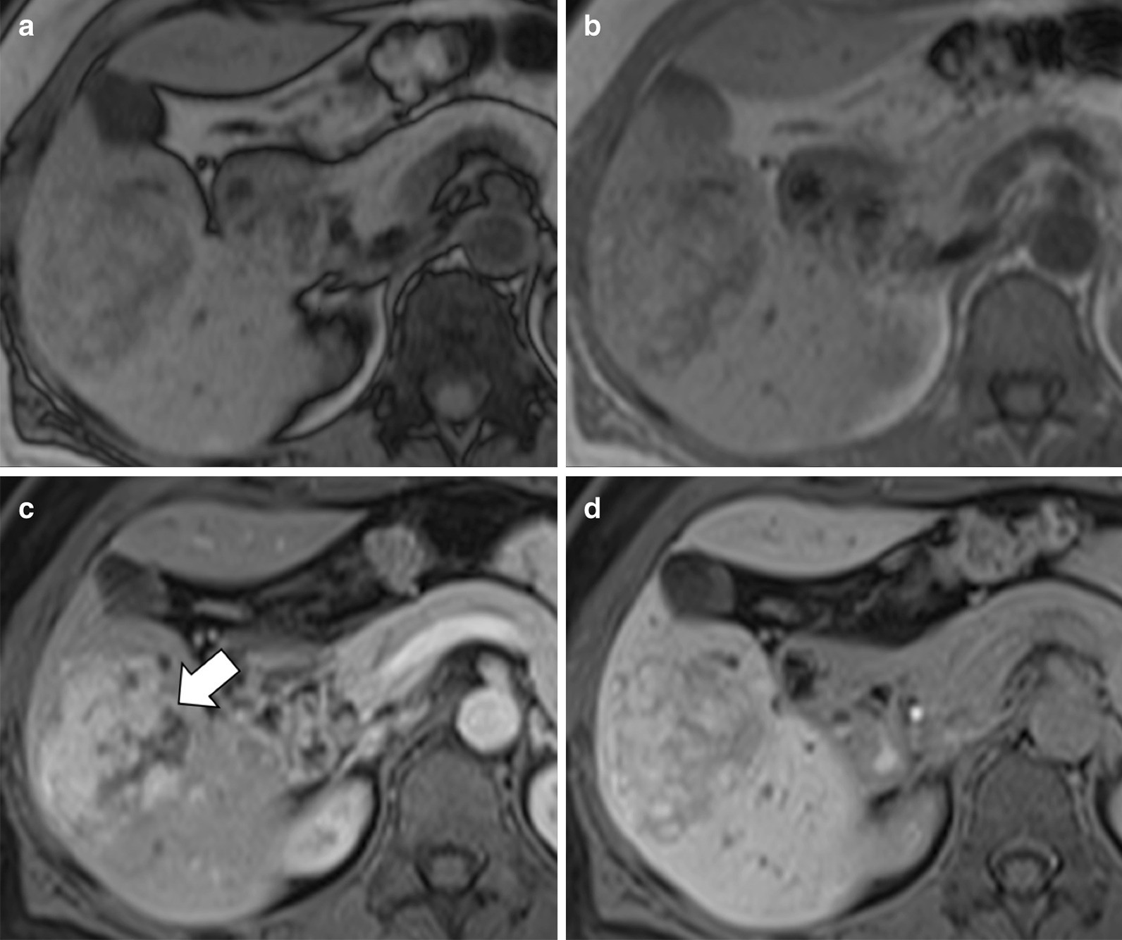 liver lesions hyperintense on hepatobiliary phase | pacs