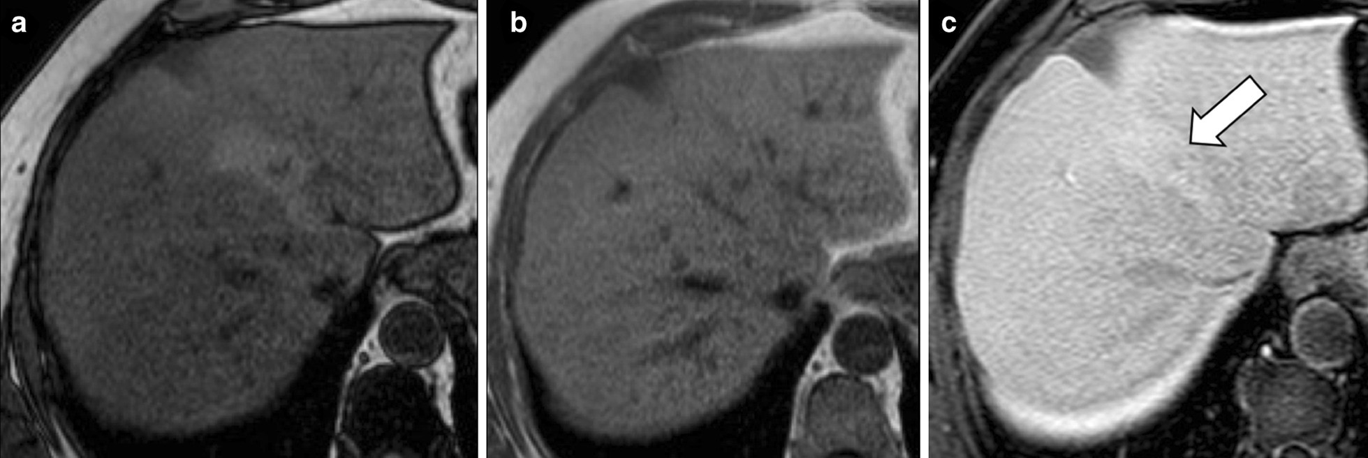 liver lesions hyperintense on hepatobiliary phase | pacs