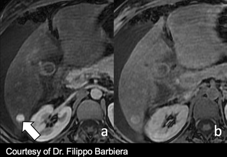liver lesions hyperintense on hepatobiliary phase | pacs