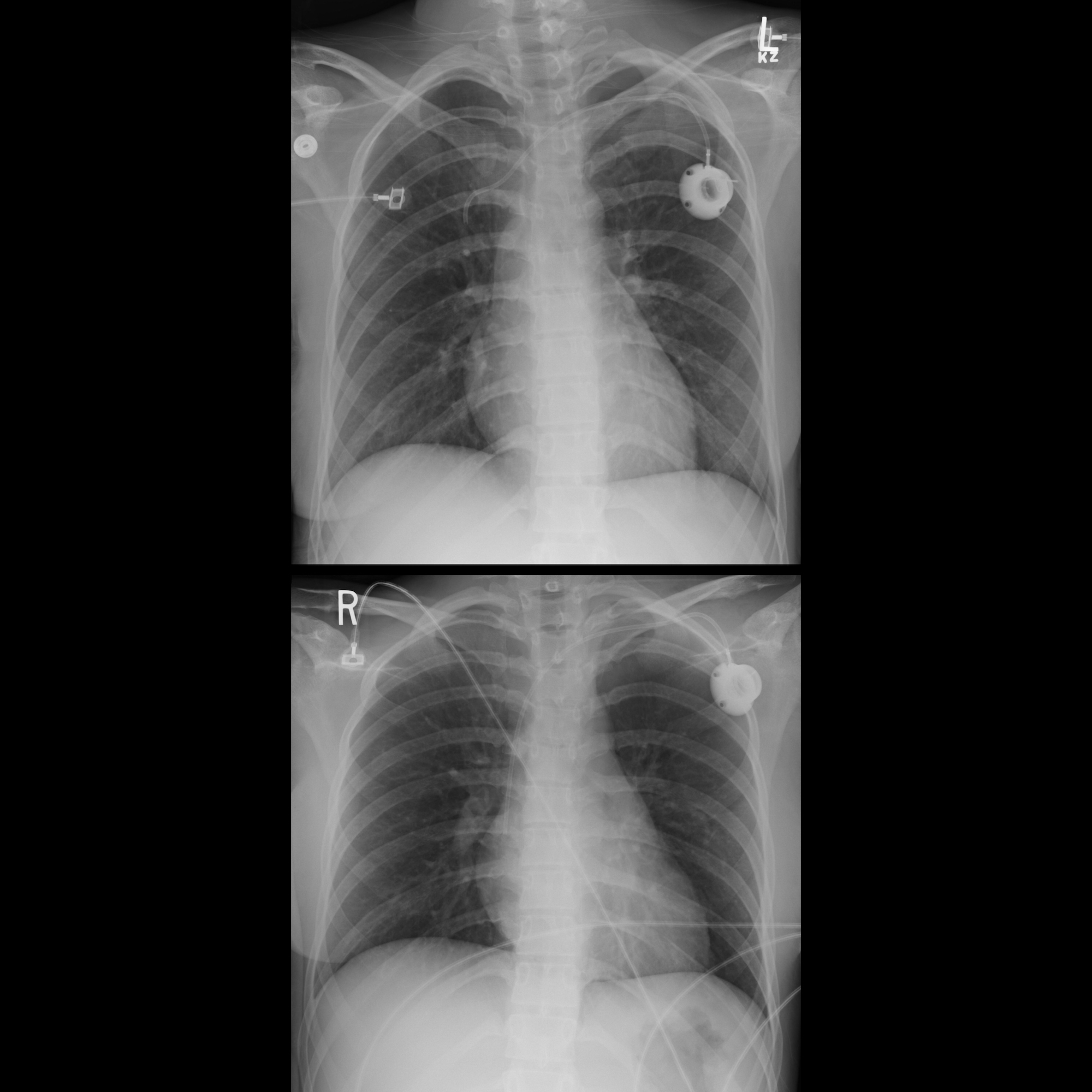 malpositioned catheter tip after placement | pacs