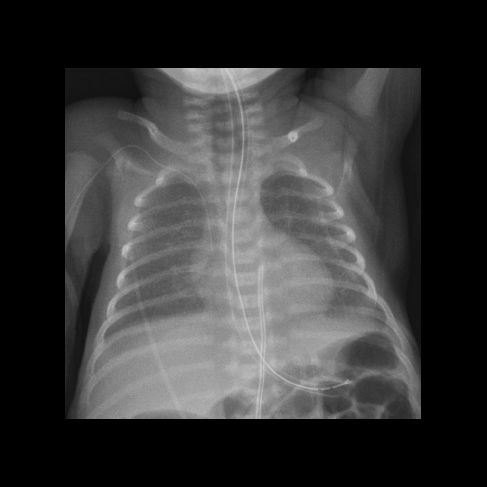 appropriate position of the PICC | pacs