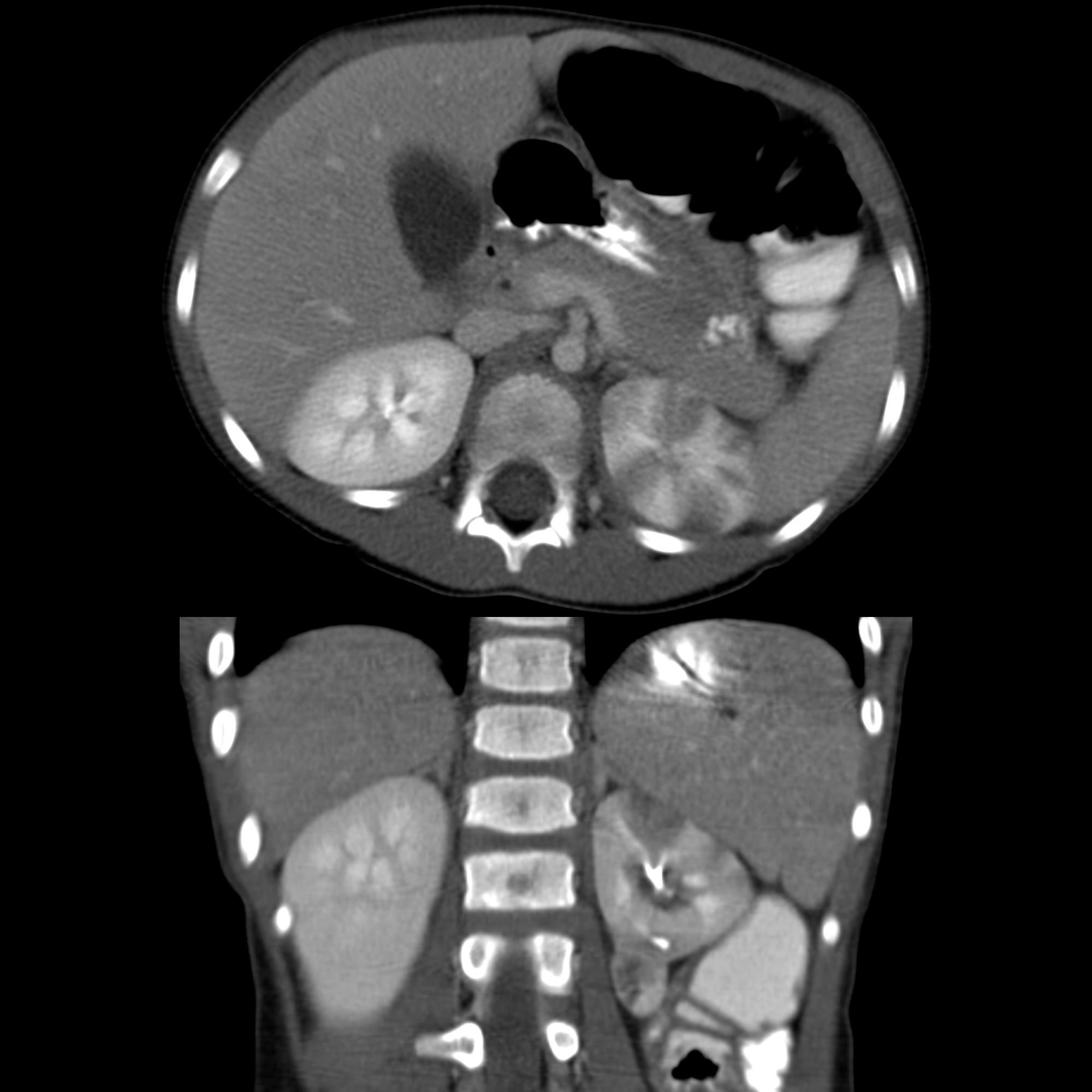Chronic Pyelonephritis Ivp