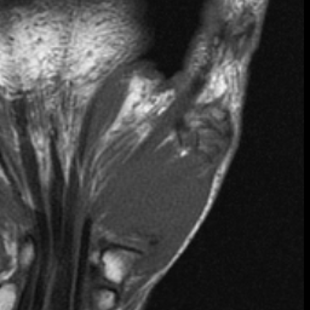Magic angle effect (MRI artifact) | pacs