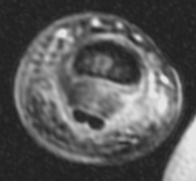 annular pulley lesions | pacs