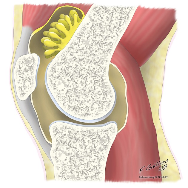 diffuse synovial lipoma | pacs