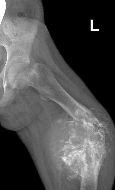 telangiectatic osteosarcoma | pacs