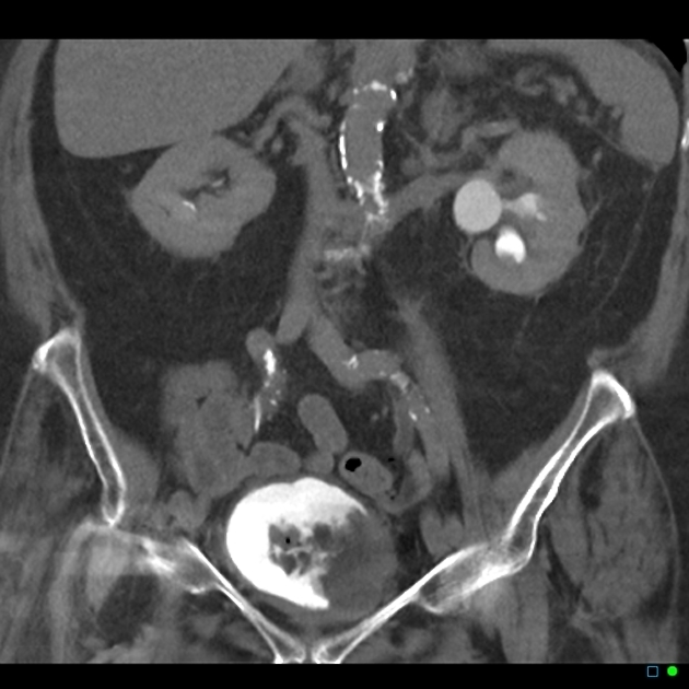 transitional cell carcinoma (TCC) of the bladder | pacs