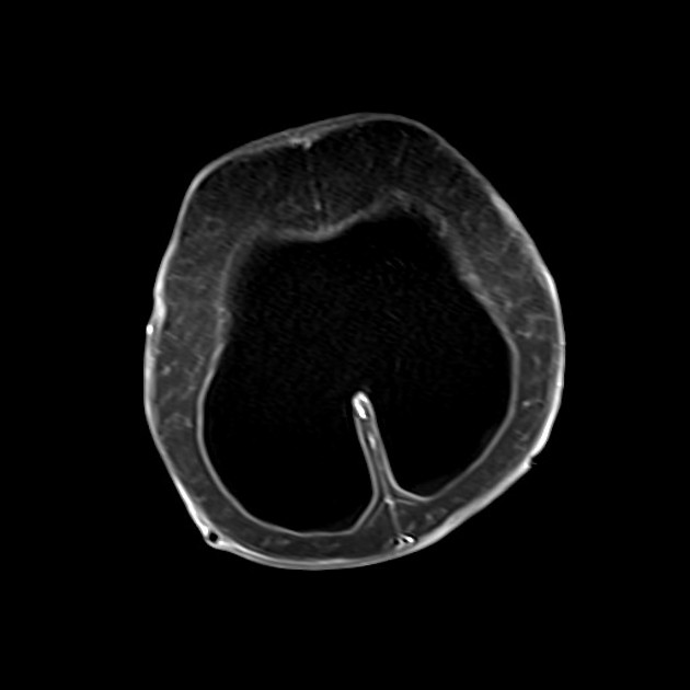 Hirnabszess mit Ventrikulitis | pacs