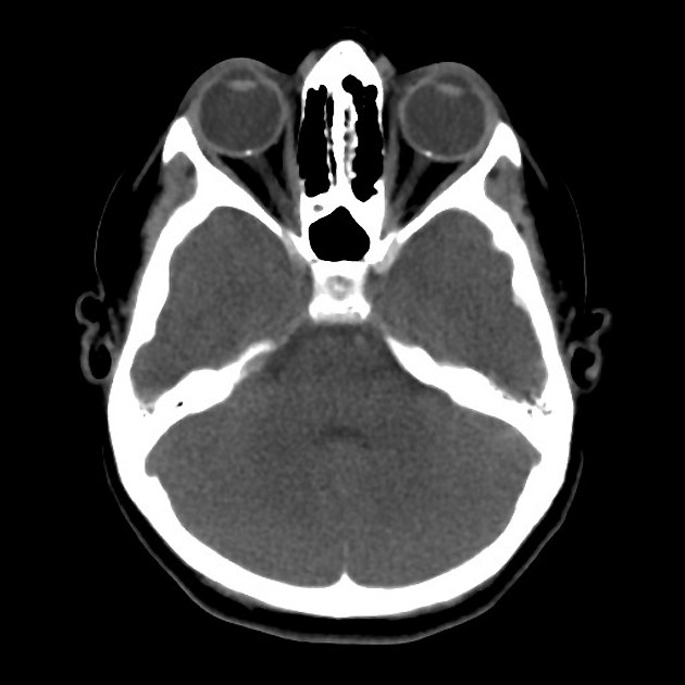 hyaline bodies of the optic disc | pacs