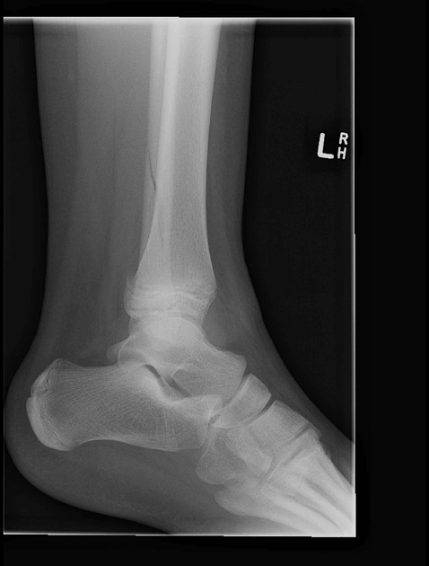 triplane fracture | pacs