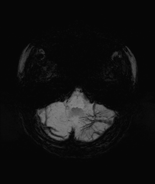 Caput medusae sign (developmental venous anomaly) | pacs