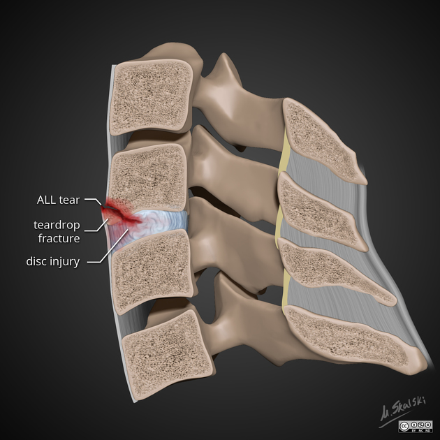 flexion teardrop fracture | pacs