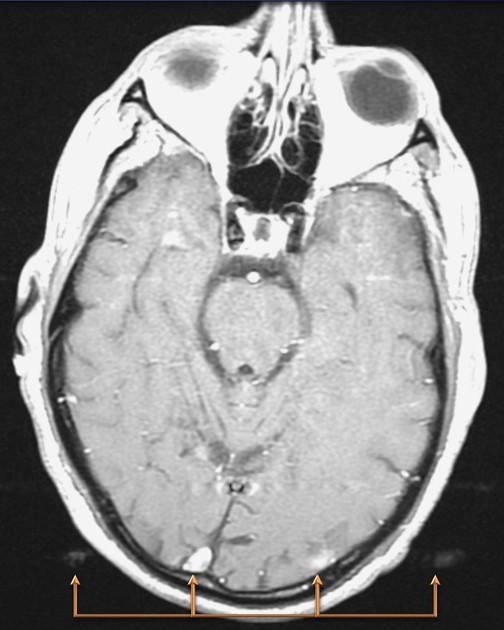 phase-encoded motion artifact | pacs