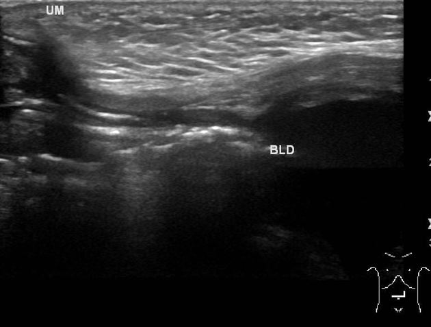 patent urachus | pacs