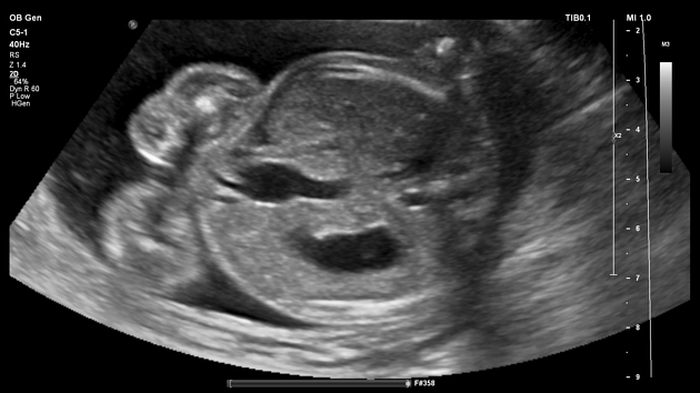 umbilical venous varix | pacs