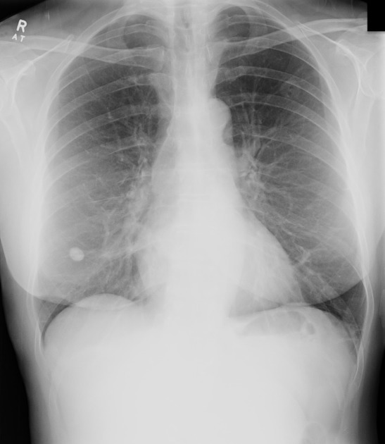 pulmonales Hamartom | pacs