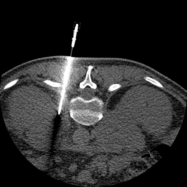 Ct Guided Adrenal Biopsy Pacs