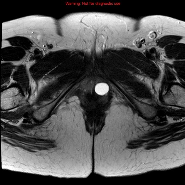bartholin gland cyst | pacs