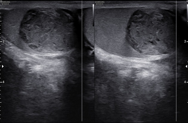 Scrotal Epidermoid Cyst Ultrasound
