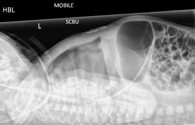 Pneumothorax beim Neugeborenen | pacs