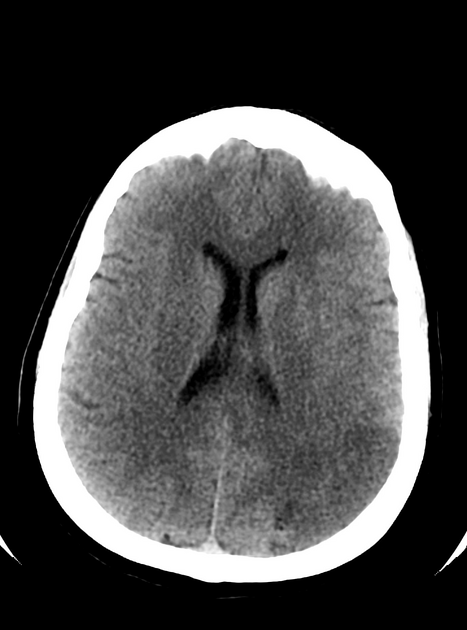 watershed cerebral infarction | pacs