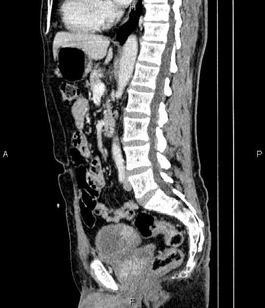 transitional cell carcinoma (TCC) of the bladder | pacs