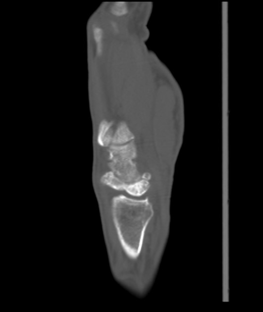 humpback deformity of the scaphoid | pacs