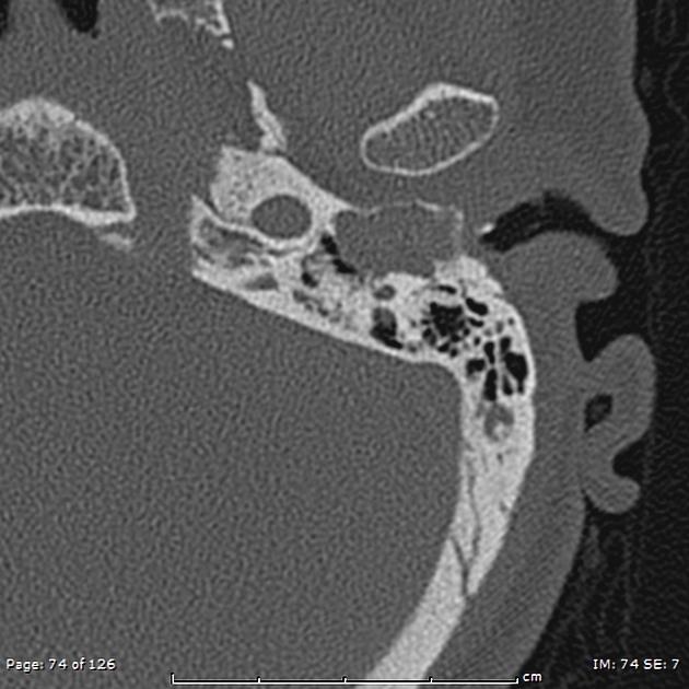 External Auditory Canal Cholesteatoma Pacs