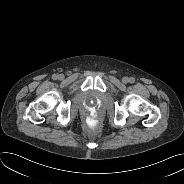 colovesical fistula | pacs