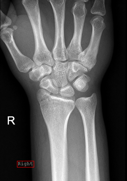 distal radial fracture | pacs