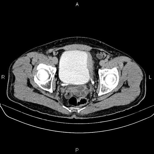 transitional cell carcinoma (TCC) of the bladder | pacs