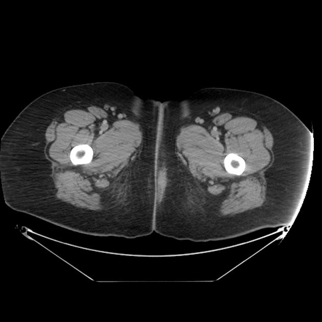 bartholin gland cyst | pacs