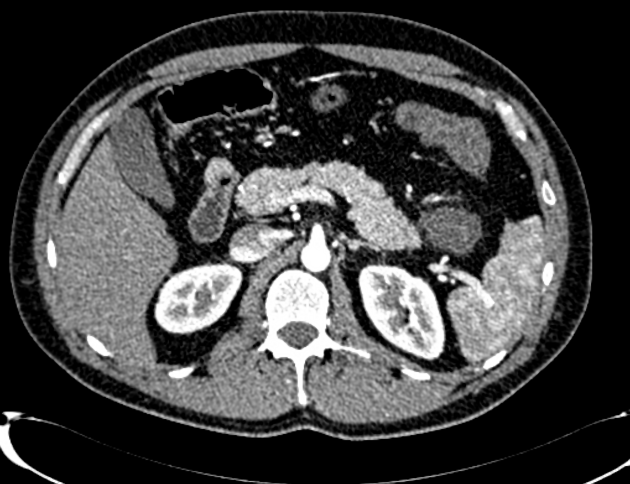 Ectopic pancreas | pacs