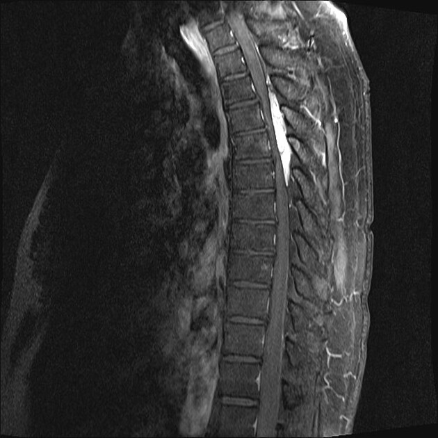 spinale epidurale Kontrastmittelaufnahme | pacs