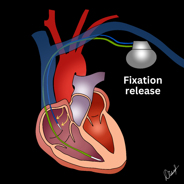 Twiddler-Syndrom | pacs