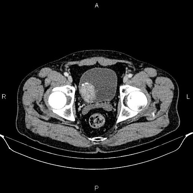 transitional cell carcinoma (TCC) of the bladder | pacs