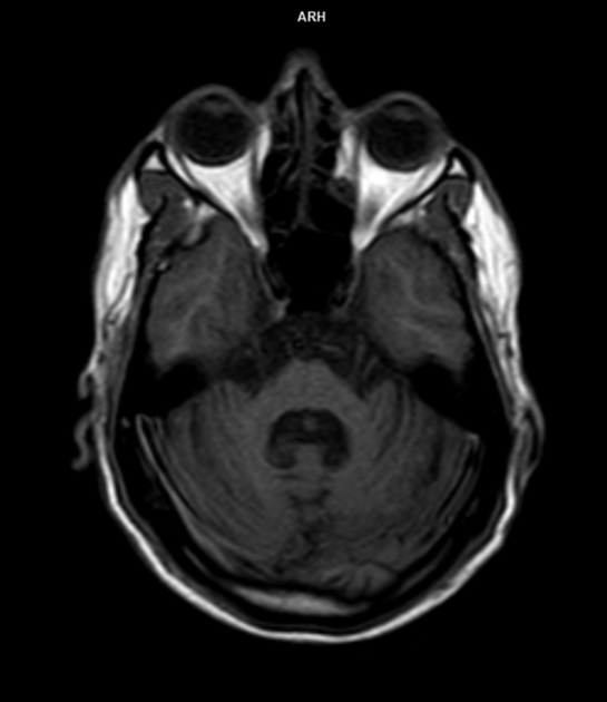 Multisystematrophie | pacs
