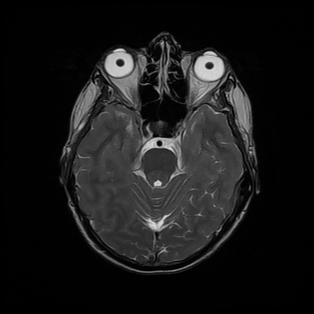 dislocation of the lens | pacs