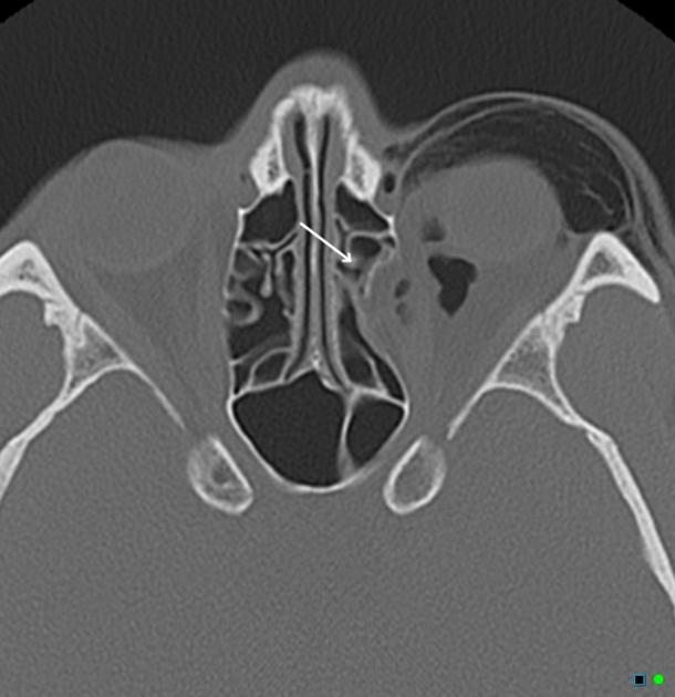 orbital blow-out fracture | pacs