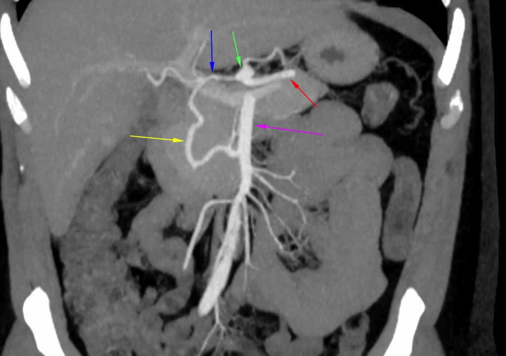Truncus-coeliacus-Kompressionssyndrom | pacs