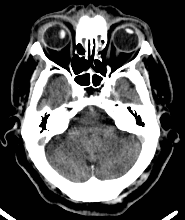 dislocation of the lens | pacs